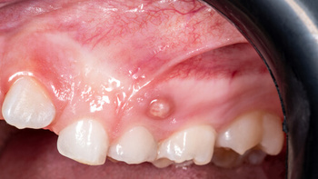 Tips on How to Pull Out a Wobbly Tooth Safely and Easily